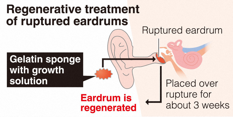 Easy regenerative treatment for eardrum damage to begin in Osaka at ...